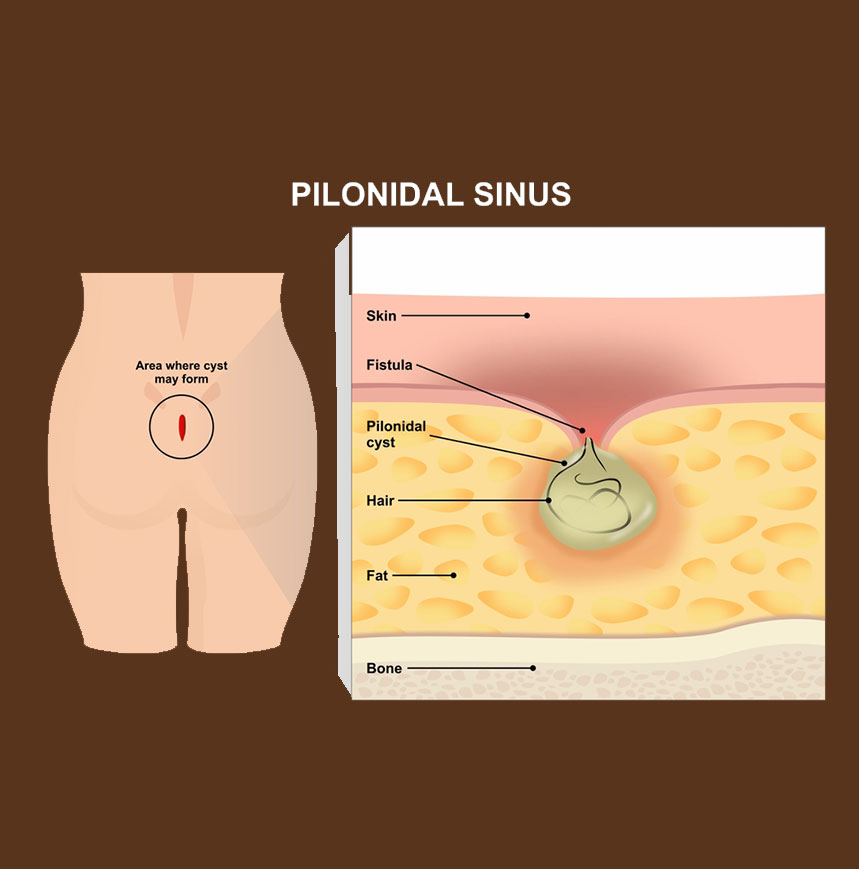 Laser Hair Removal After Pilonidal Cyst Surgery Infoupdate Laser Hair Removal After Pilonidal Cyst Surgery Infoupdate